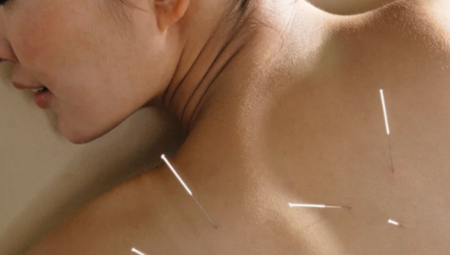 Follow up treatment - 1 hour | Eastern Plains Acupuncture & Wellness